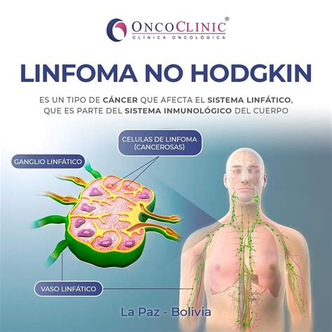 Linfoma No Hodgkin Linfoma No Hodgkin Linfoma Difuso De Células B