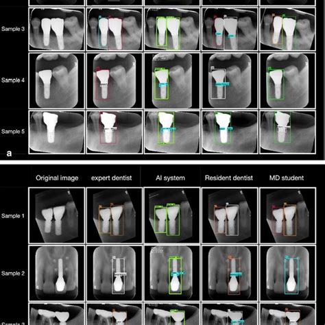 Example Periapical Radiographs Showing Areas Of Bone Loss Detected By Download Scientific