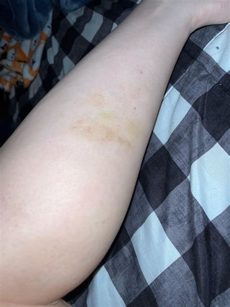 Random Bruising And Bad Leg Cramps Rmedical