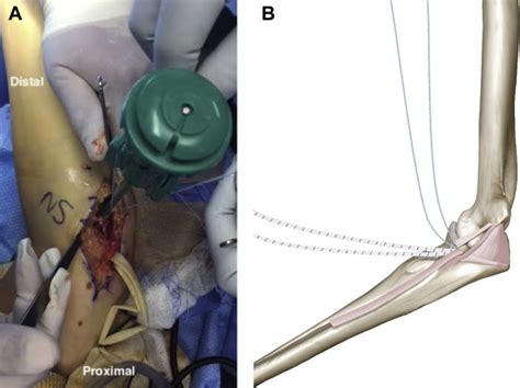 Ulnar Collateral Ligament Rehabilitation