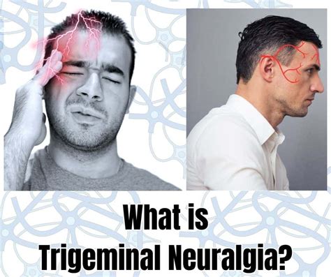 What Is Trigeminal Neuralgia 3 Reasons Upper Cervical May Help Revive Upper Cervical Chiropractic