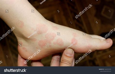 Erythema Multiforme Symptome Ursachen Diagnose Und Behandlung Wheceg