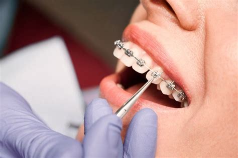 Adults Braces Types Costs And How They Work Orthodontics Getting