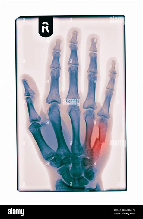 Broken Metacarpal Bone Coloured X Ray Of The Bone Of A Patients Right Hand R Seen From Above