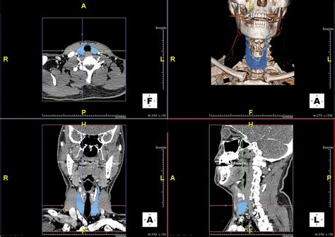 Semiautomated Thyroid Volumetry Using 3d Ct Prospective Comparison