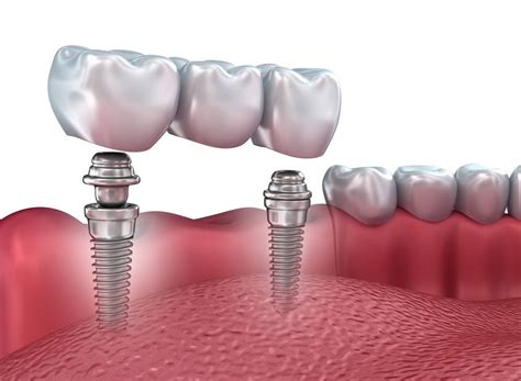Prótesis Sobre Implantes Clínica Dental Larrañaga