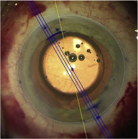 Femto Ak Equivalent To Toric Iol For Mild To Moderate Astigmatism