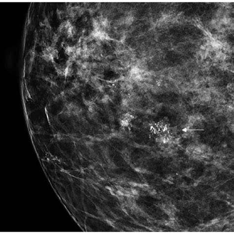 Spot Magnification Mammogram With A Small Cluster Of Pleomorphic Download Scientific Diagram