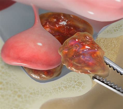 Tumor Resection Fotroshealth
