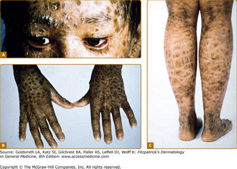 The Ichthyoses Plastic Surgery Key