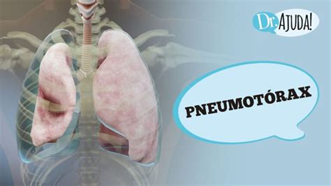 Tipos De Pneumotórax Entenda As Diferenças E Tratamentos Actualizado