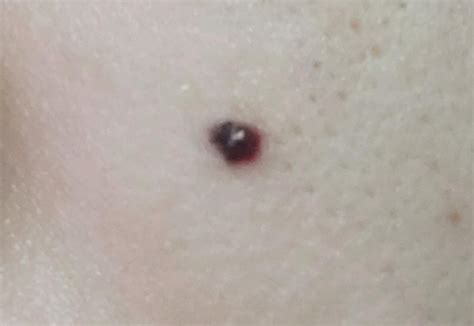 Are All New Raised Mole Suspicious Rmelanoma