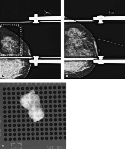 Needle Localization Biopsy Of Nonpalpable Breast Lesions Plastic