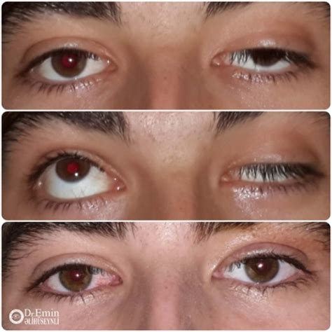 Ptoz Nədir Müalicəsi Necə Aparılır