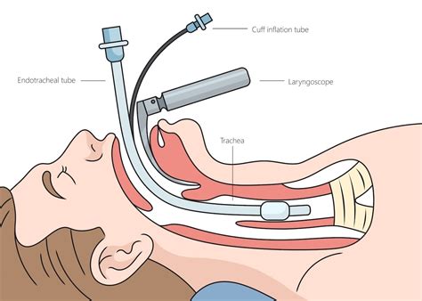 Intubated Vs Ventilator