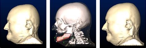 Figure 2 From Finite Element Simulation Of Soft Tissue Deformation