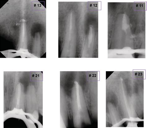 Periapical Radiograph Showed Conventional Root Canal Obturation With