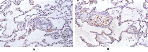 A Amniotic Fluid Embolization Hande Stain B Amniotic Fluid