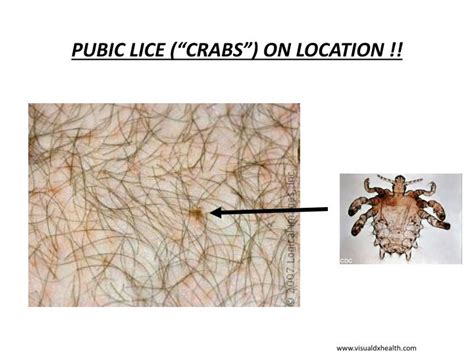 What Do Crabs Look Like Pubic Lice At Corrine Fitzpatrick Blog