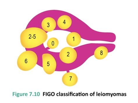 Leiomyoma Flashcards Quizlet