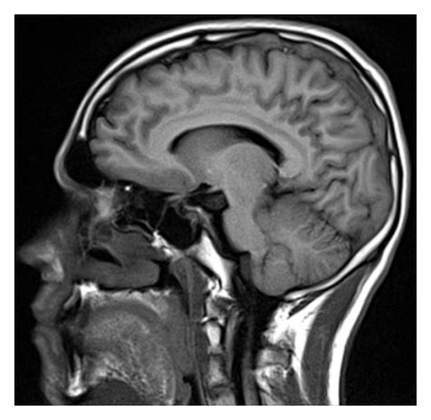 Mutation In The Prothrombin Gene G20210a As A Cause Of Cerebral Venous Thrombosis Pmc