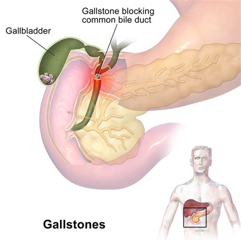 Difference Between Cholecystitis And Cholelithiasis Cholecystitis Vs