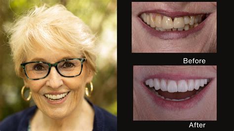 Implant Supported Partials And Dentures Envision Dental Spa