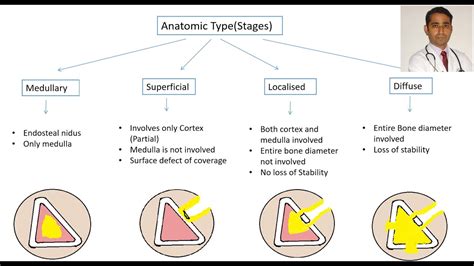 Classification Of Chronic Osteomyelitis Cierney Mader Classification