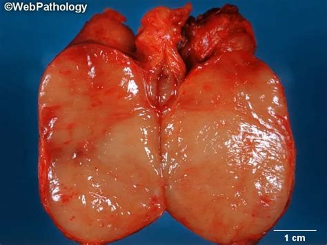 Mixed Cellularity Hodgkin Lymphoma