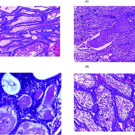 A Plexiform Pattern Of Ameloblastoma H And E Stains Â100 B Download Scientific Diagram