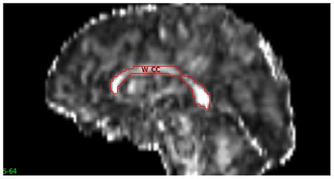 Mid Sagittal Slice Showing Tracing Of The Whole Corpus Callosum