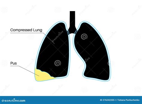 Pyothorax Pleural Empyema Cartoon Vector 276242205