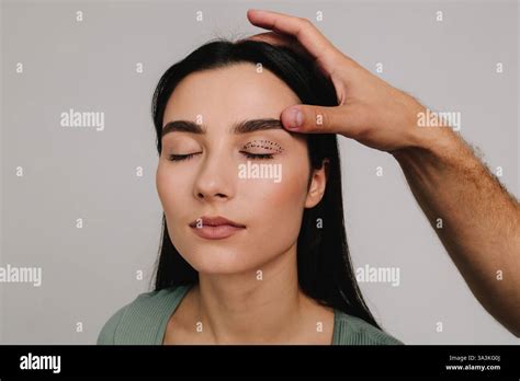 Marking Blepharoplasty Doctor Is Drawing Up Plan For Upper Eye Lid Surgery With Medical Marker