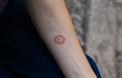 How To Use Hydrogen Peroxide For Ringworms