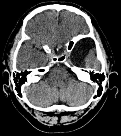 Arachnoid Cysts Leptomeningeal Cysts Arachnoid Diverticula