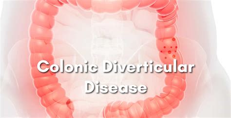Colonic Diverticular Disease Alpine Surgical Practice Colorectal