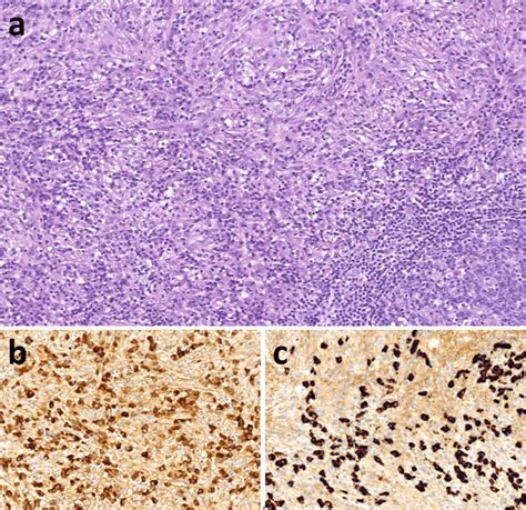 A Igg4 Related Hypophysitis Is Characterized By A Prominent Download Scientific Diagram