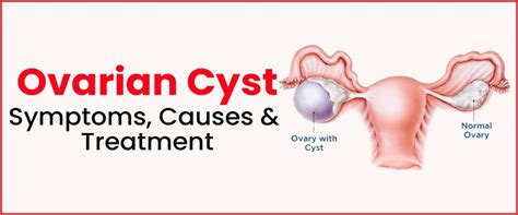 Ovarian Cyst Treatment And Care Imprimis Ivf Centre