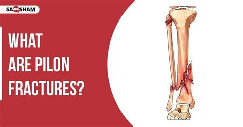 Life After Pilon Fracture At Ruby Najar Blog