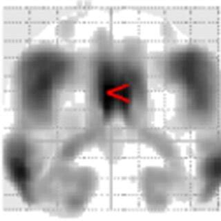 Sample Output Of SPM A Group Wise Comparison Was Performed On Download Scientific Diagram
