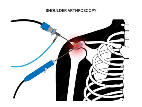 Rotator Cuff Tear With Impingement At Angela Babcock Blog