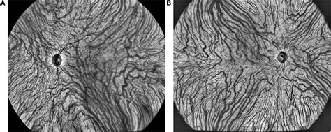 Frontiers Three Dimensional Choroidal Vascularity Index In Central Serous Chorioretinopathy