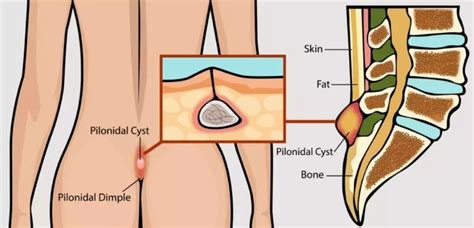 Explore Some Information On Pilonidal Sinus Surgery