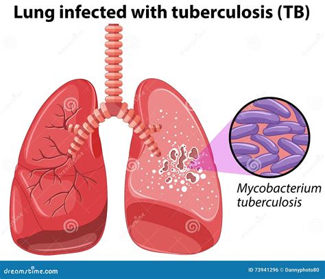 Lung Infected With Tuberculosis Stock Vector Illustration Of Virus