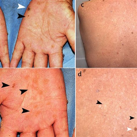 Clinical Presentation A Multiple Yellowish Dotted Papules On The Download Scientific Diagram