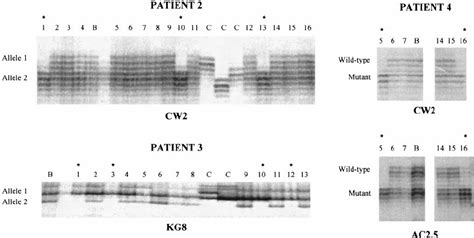 Analysis Of Microsatellite Markers On Chromosome 16p13 3 In Different Download Scientific