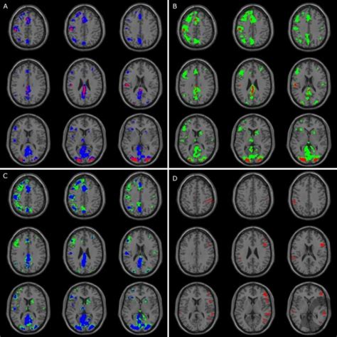 the activation maps found in ica aroma 1 regression red and