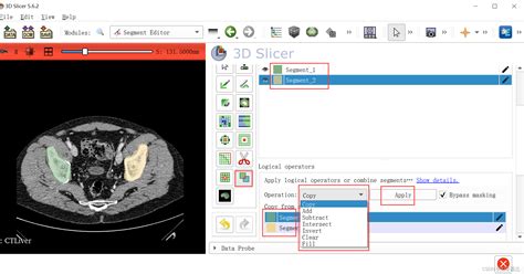 3d Slicer的学习（二） 图像的分割3dslicer怎么调整窗宽窗位 Csdn博客