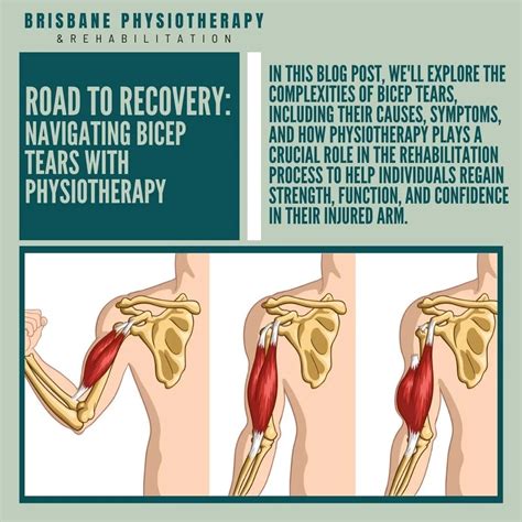 Bicep Tears Torn Bicep Symptoms Causes Physio And Rehab Brisbane