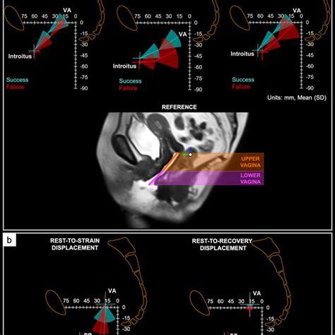 Vaginal Configuration And Displacement In The Anatomic Space Visual Download Scientific Diagram
